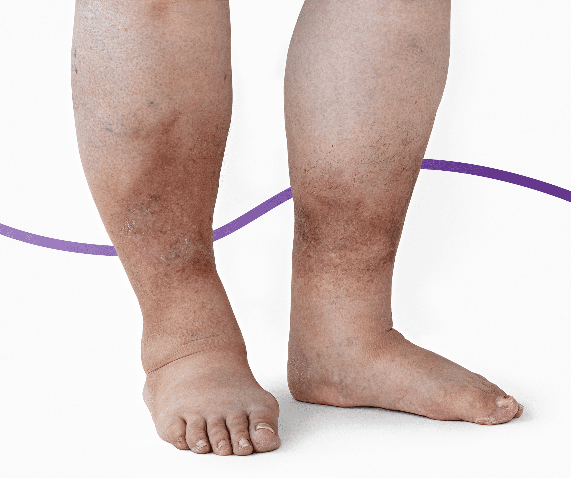 Diabetic Foot Problems Causes Symptoms And Treatment The Feet People Podiatry