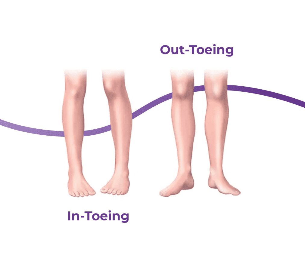 In-Toeing & Out-Toeing: Causes, Symptoms & Treatment | The Feet People ...