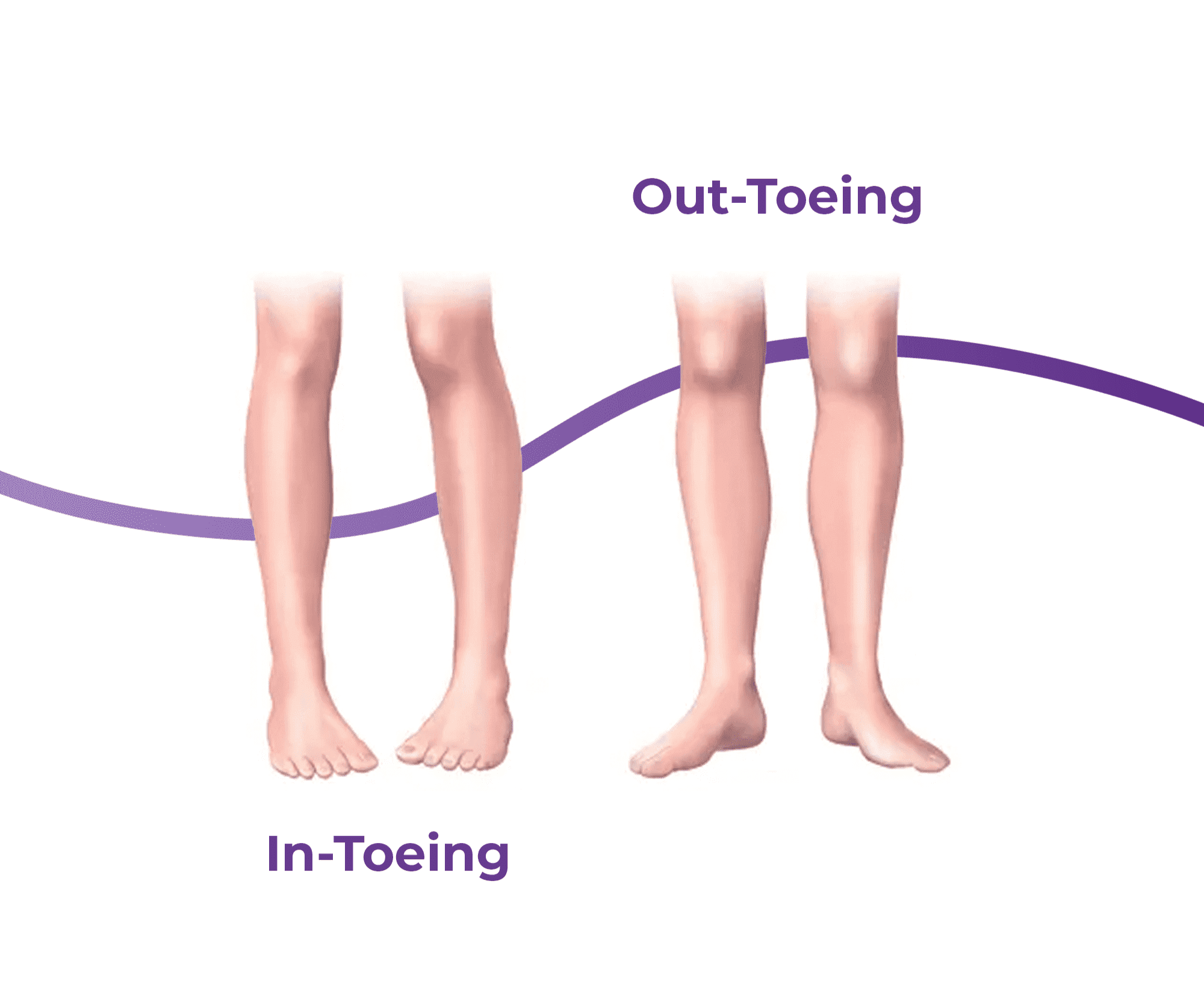 In-Toeing and Out-Toeing: Causes, Symptoms and Treatment | Podiatrist